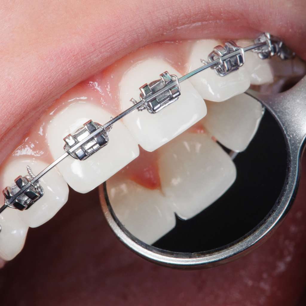 Ortodoncia con Brackets Metálicos » Marketplace Colombia